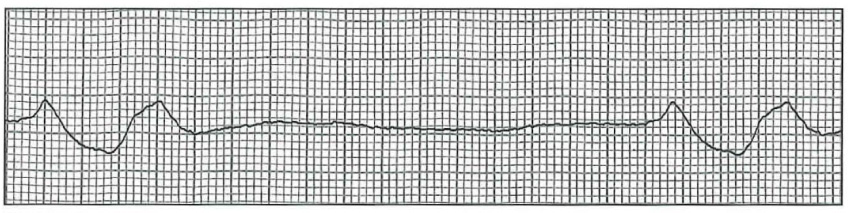Pulseless Electrical Activity Vs Ventricular Fibrillation