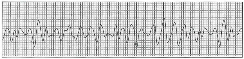 Ventricular fibrillation pulseless electrical activity ecg - Flexarts