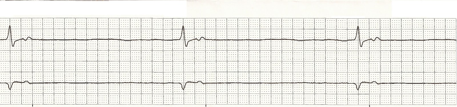 Pulseless Electrical Activity Ecg