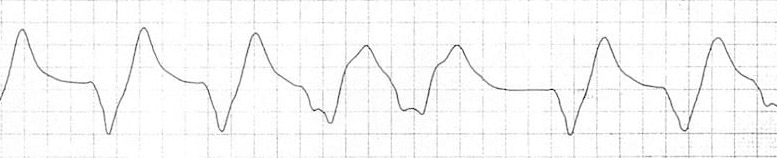 Hyperkalemia Ecg Strip