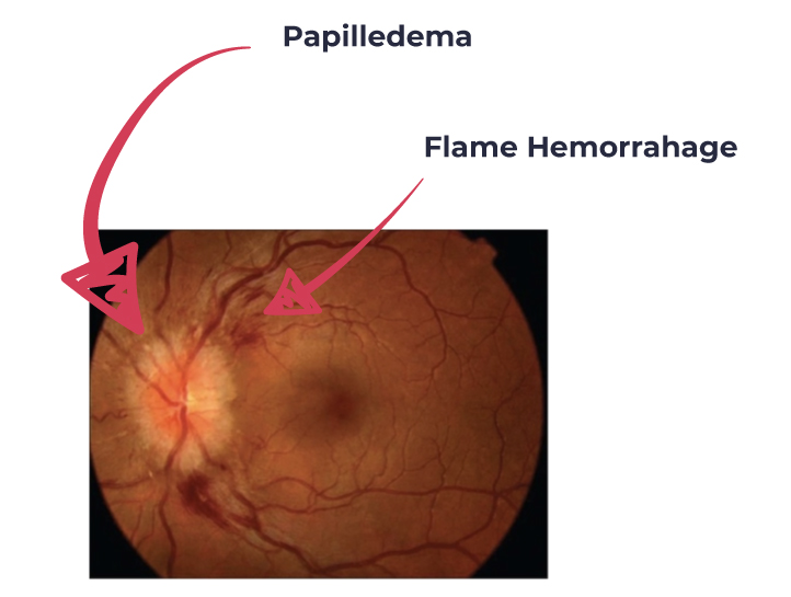 Blurry Vision and Hypertension