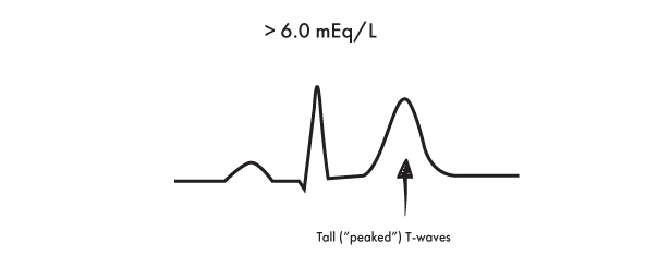 Peaked T Waves