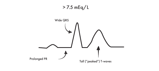 Hyperkalemia Peaked Waves Ekg Wave Pulseless Electrical Activity ...