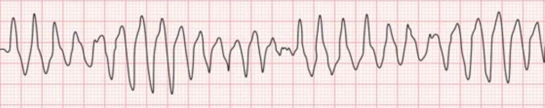 Torsades De Pointes Rhythm Strip