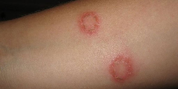 Does ringworm itch - lunchulsd