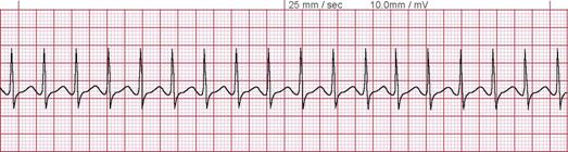 Supraventricular Tachycardia Rhythm Strip